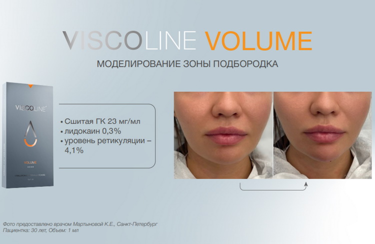 Viscoline® Volume | 23 мг/мл | Филлер плотный волюметрик | Купить в ...