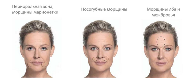 Viscoline® Balance | 23 мг/мл | Филлер средний | Купить в Москве с ...